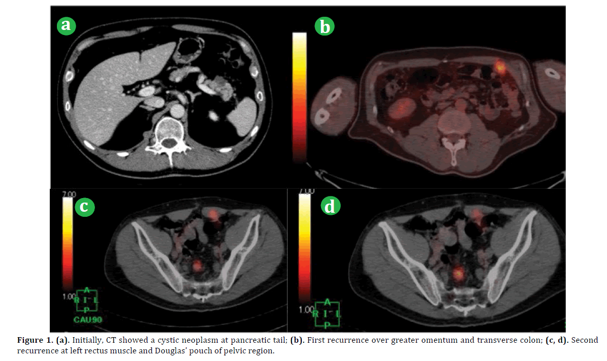 Nodules In The Pouch Of Douglas Colorectal Surgery