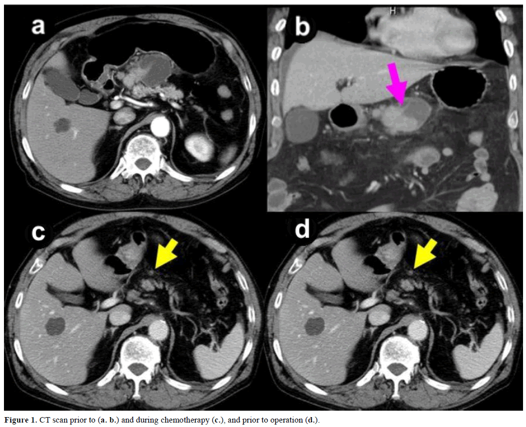 Acinar Cell Carcinoma of the Pancreas: A Possible Role of S-1 as ...
