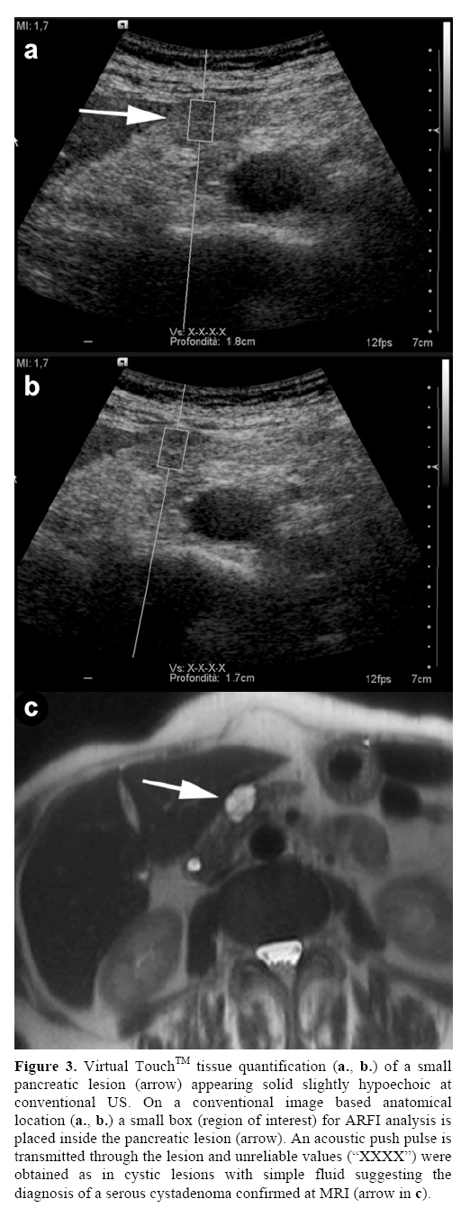 Pancreatic Serous Cystadenoma Ultrasound