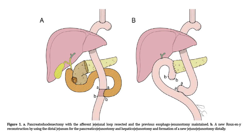 Jejunojejunostomy Image AMICUS Illustration of amicus,surgery ...
