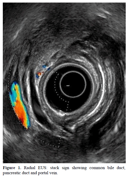 Endoscopic Ultrasound and Pancreas Divisum | Insight Medical Publishing